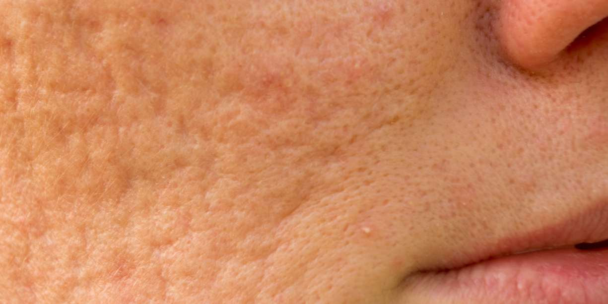 Acne Marks vs. Acne Scars: Understanding the Battlefield of Blemishes ...