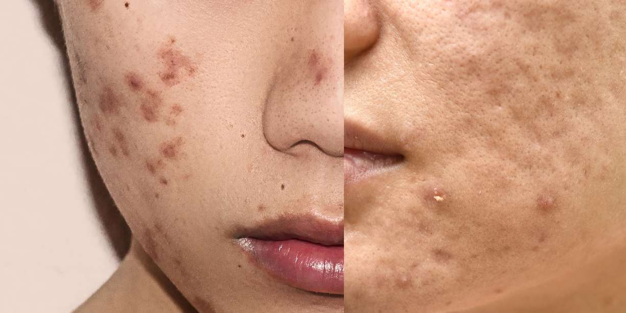 Acne Marks vs. Acne Scars: Understanding the Battlefield of Blemishes ...